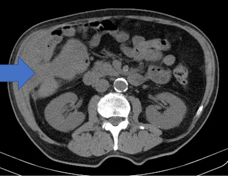 Cancer de colon drept invaziv local: diagnosticare, tratament si ...